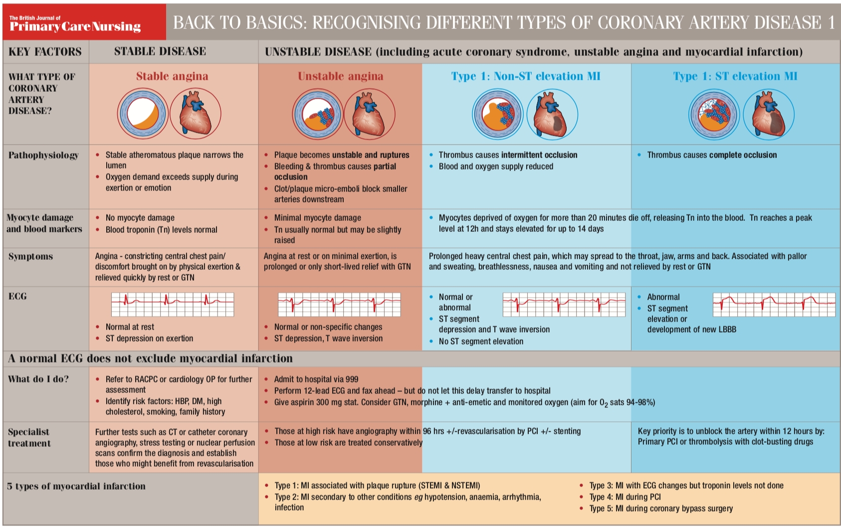 Back To Basics Recognising Different Types Of Coronary Artery Disease